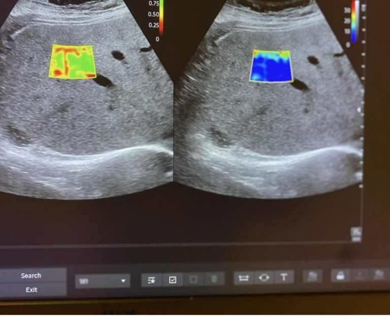 Valutazione non invasiva della Fibrosi Epatica mediante Elastografia ...